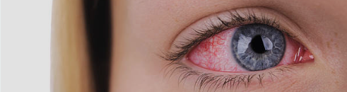 Un remède efficace contre les conjonctivites